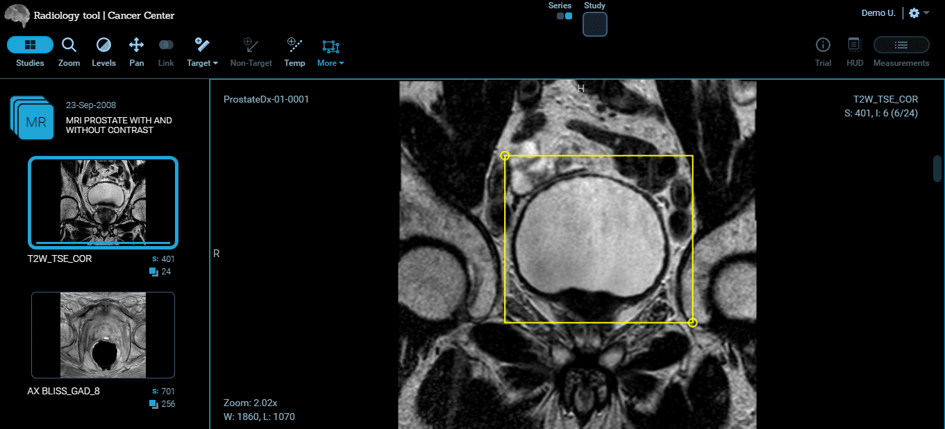 Machine learning in cancer diagnosis - Cancer Center.ai - AI in Oncology