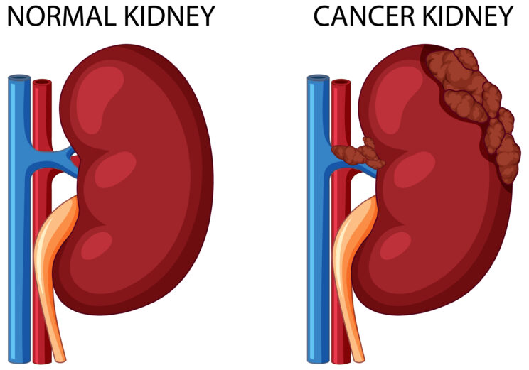 World Kidney Cancer Day: Empowering Individuals Through Knowledge and ...